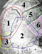 JFK Skull X-Ray - Rear Flap